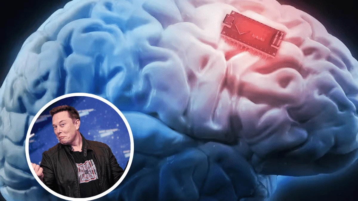 Elon Musk Lo Hizo De Nuevo Neuralink Implantó Su Primer Chip Cerebral