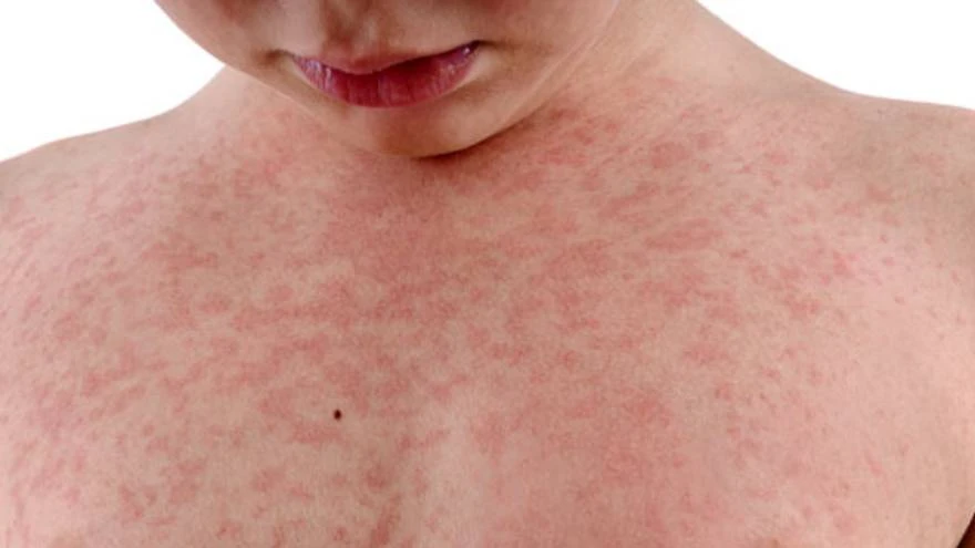 ESCARLATINA: qué la PROVOCA y qué tan GRAVE puede ser