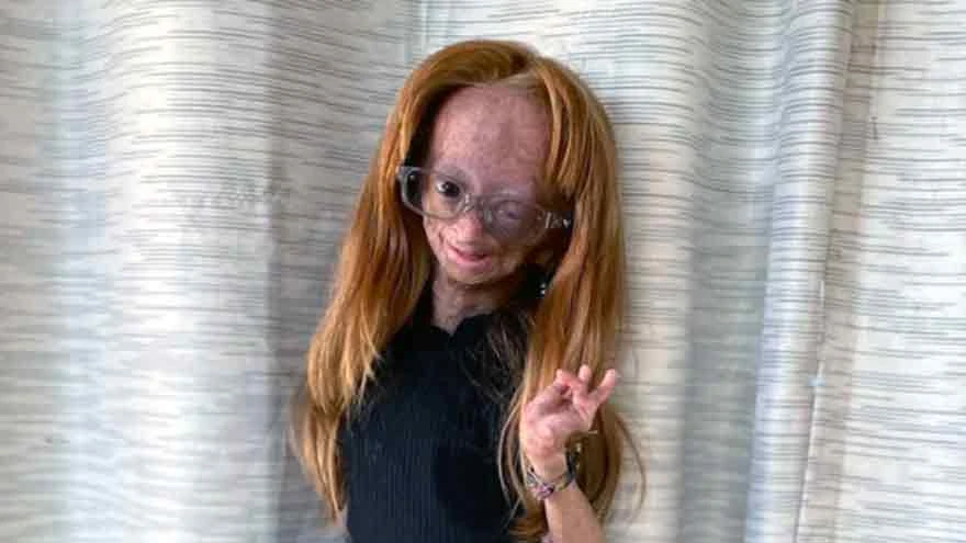 Murió la youtuber que inspiró la película de Benjamin Button